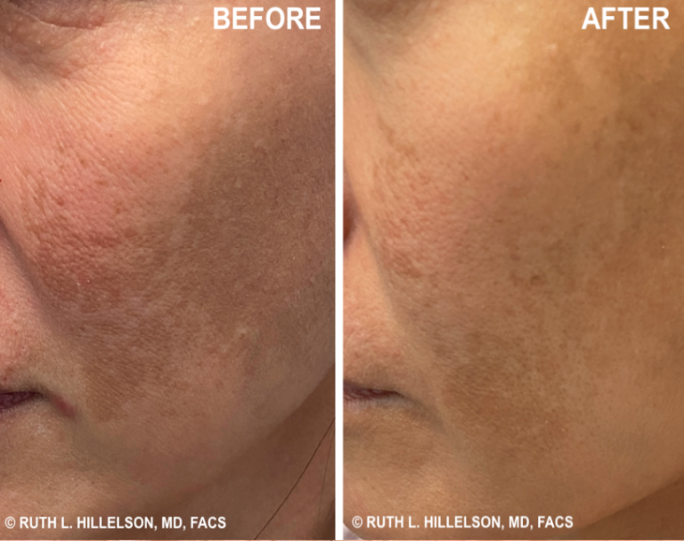 PicoSure | Richmond, VA