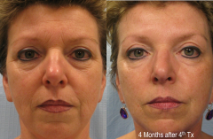 Tixel ® Skin Resurfacing