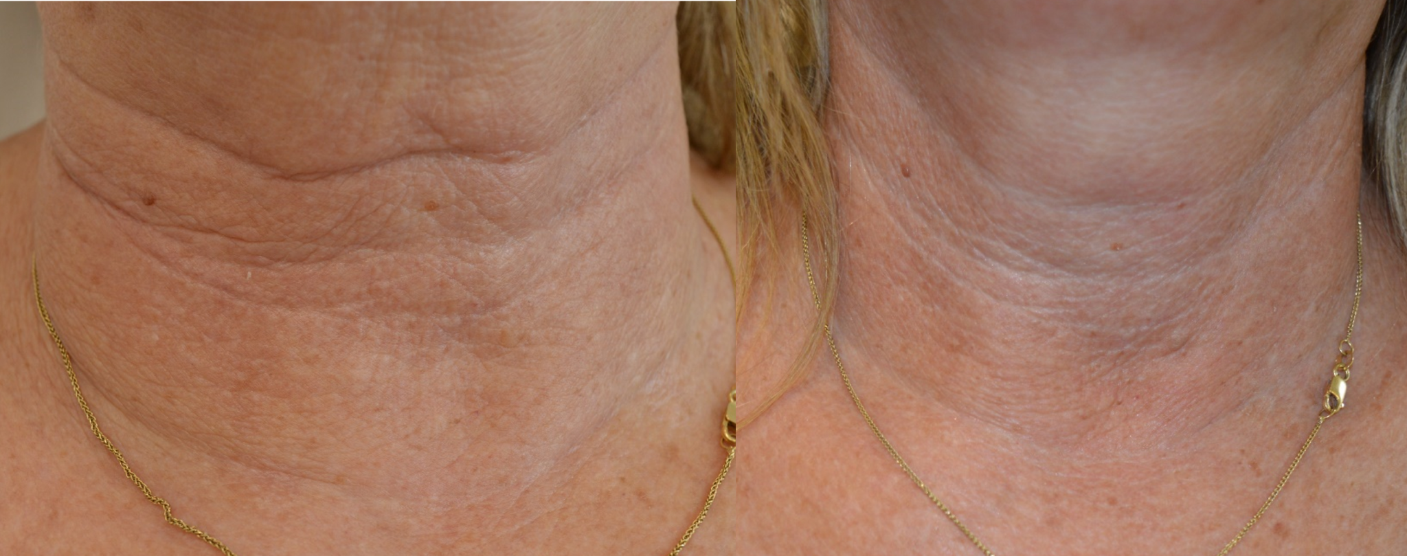 Tixel ® Skin Resurfacing