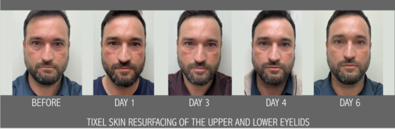 Tixel ® Skin Resurfacing