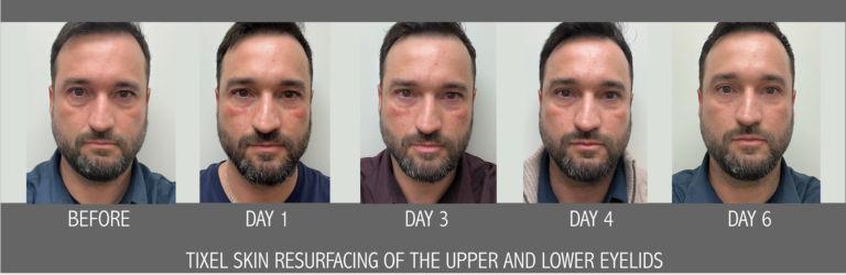 Tixel ® Skin Resurfacing