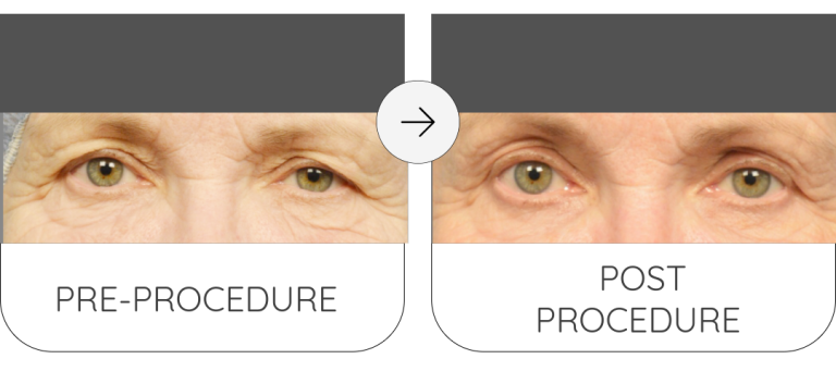 Tixel ® Skin Resurfacing