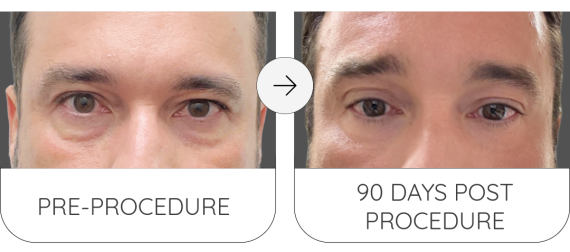 Tixel ® Skin Resurfacing
