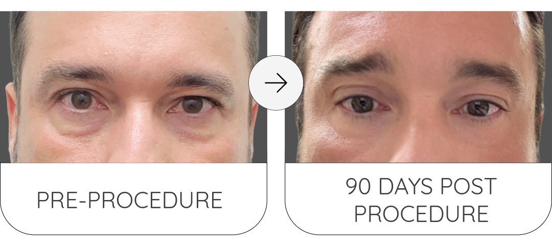 Tixel ® Skin Resurfacing